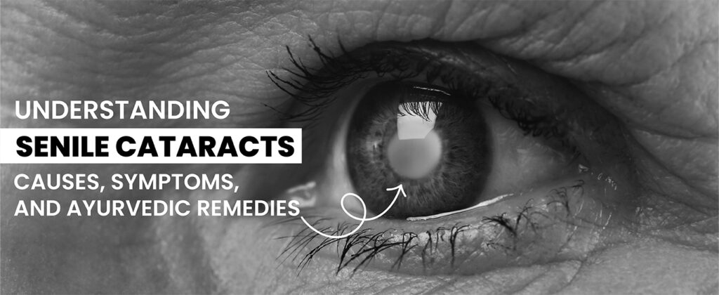 Senile Cataracts: Causes, Symptoms, and Ayurvedic Remedies